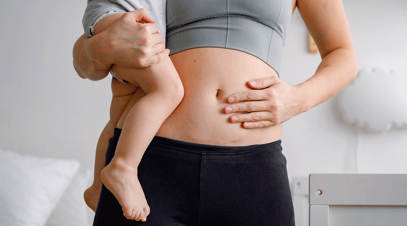 LSCS Care: Your Guide to a Safe and Healthy Recovery - Abhisri Hospital